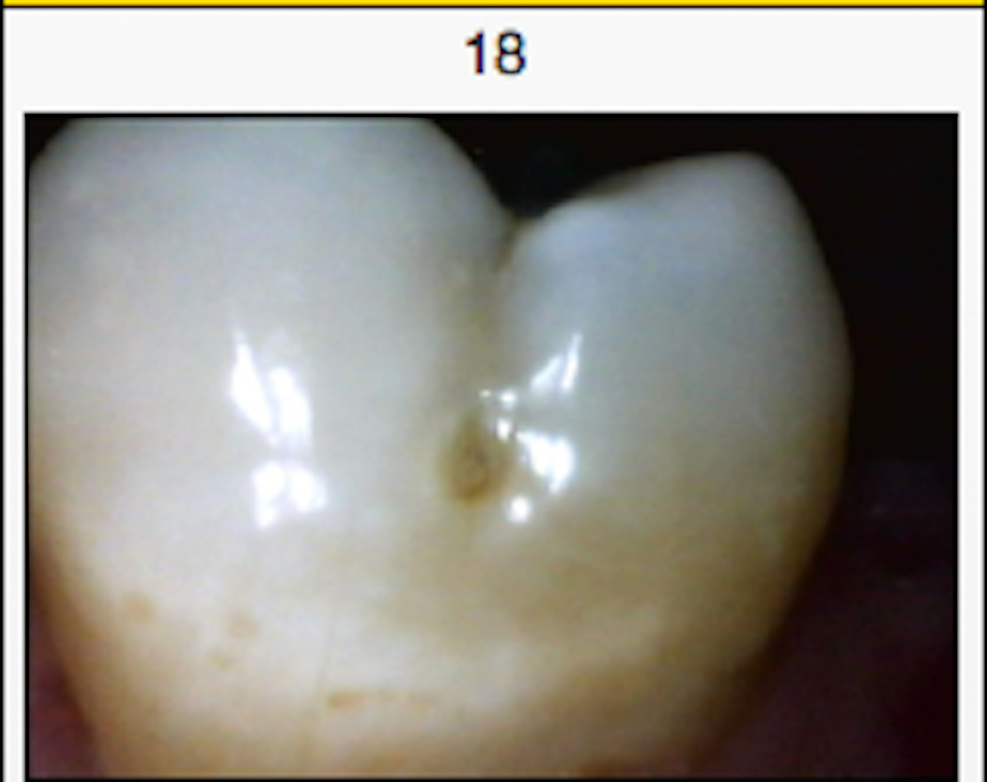Implementing Cambra In The Private Practice A Clinical Report Dentistry Iq