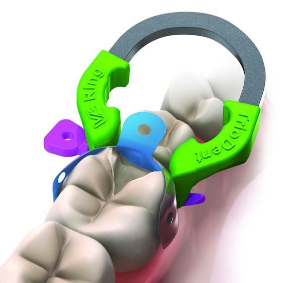 Triodent introduces V3 SuperCurve kit for Class II restorations ...