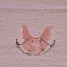 Hawley appliances: what they can do for your dental practice | Dentistry IQ