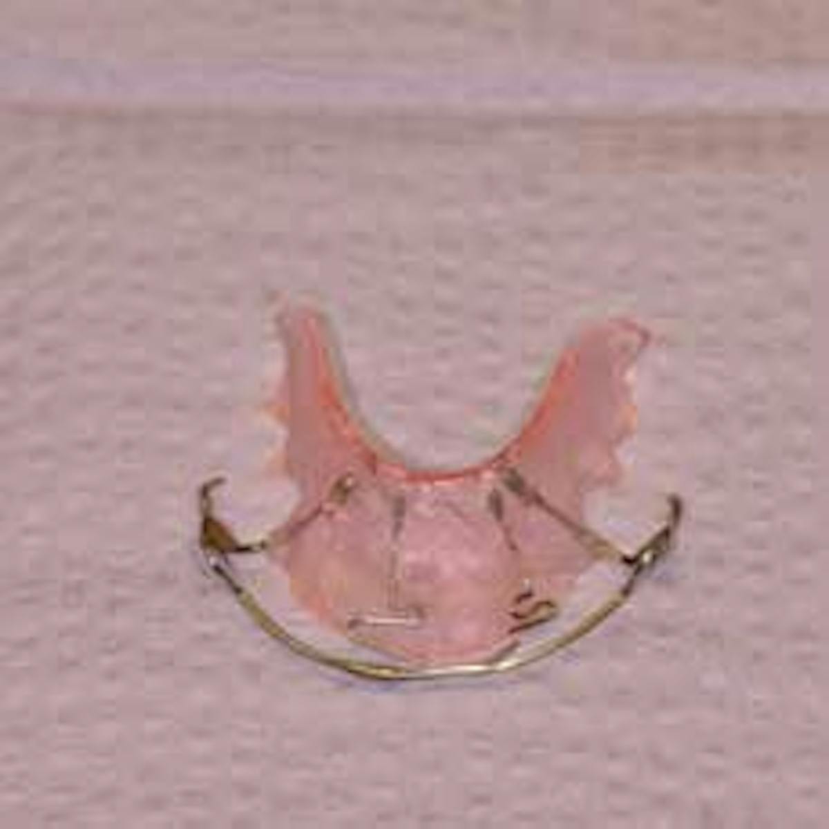 Hawley appliances: what they can do for your dental practice | Dentistry IQ