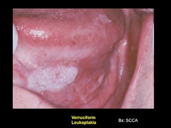 Human Papillomavirus And Oral Cancer Dentistryiq