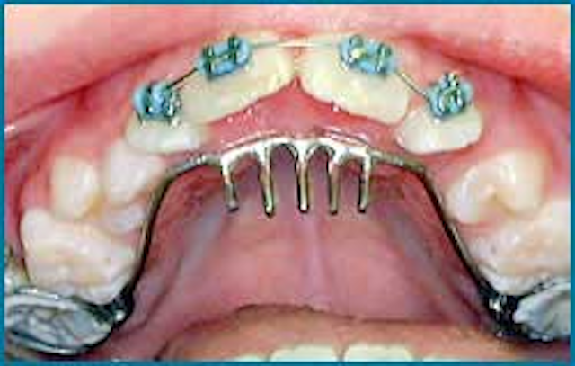 Habit appliances for the general dentist | DentistryIQ