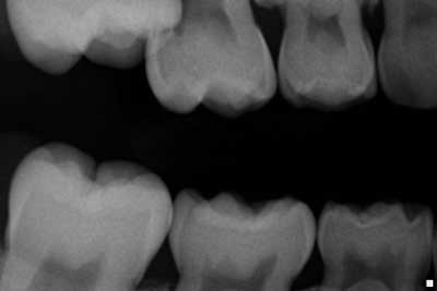 Orthodontic options for the ectopic eruption of a maxillary first molar ...