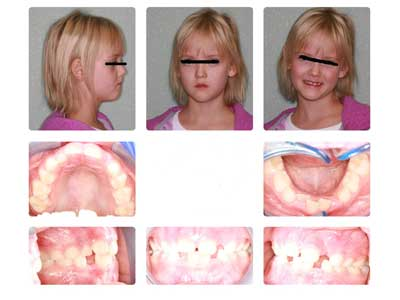 Orthodontic options for the ectopic eruption of a maxillary first molar ...