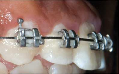 Braces: the good, the bad, and the ugly | Dentistry IQ