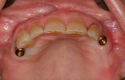 Claspless, removable partial dentures using implant-supported Locator ...