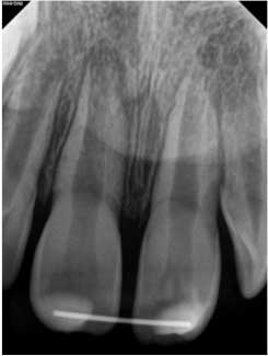 Trauma and horizontal root fractures of the anterior teeth: A review ...