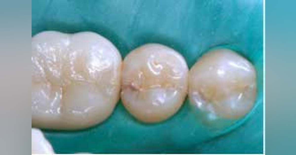 The 3 modes of a universal adhesive: Part III -- selective-etch ... The 3 modes of a universal adhesive: Part III -- selective-etch ...