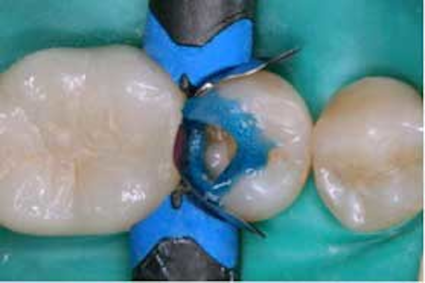 The 3 modes of a universal adhesive: Part III -- selective-etch ...