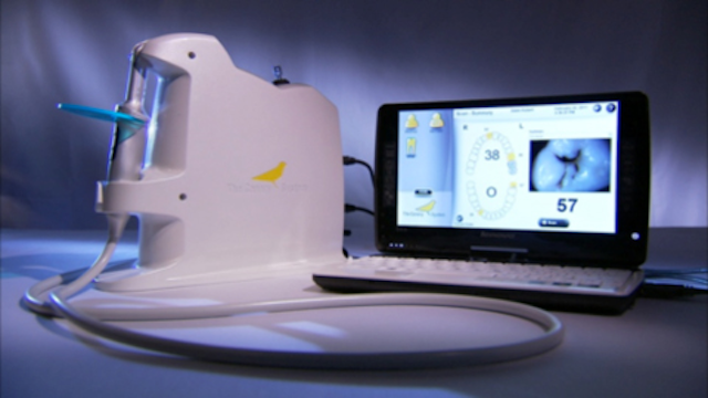 The Canary System: a solution for detecting caries around restoration ...