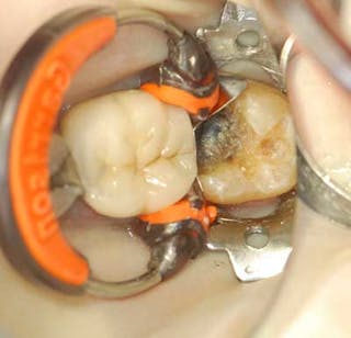 Restoring the difficult Class II with composite | Dentistry IQ