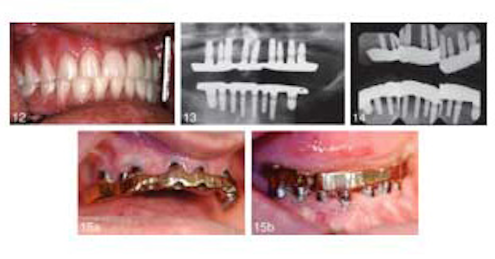 Improved dental implant surface and hygiene boost restoration success ...