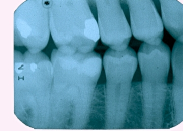 The Canary System: a solution for detecting caries around restoration ...