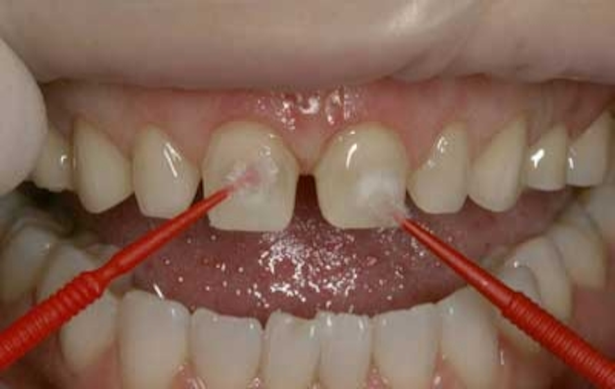 Intraosseous local anesthesia | Dentistry IQ