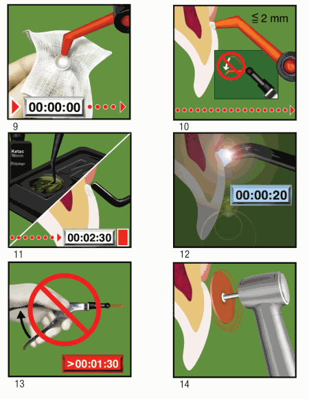Technique Guide: 3M ESPE's Ketac Nano in the Quick Mix Capsule ...