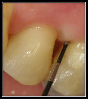 Cervical Enamel Projection