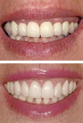 Esthetic management of a flat periodontium through orthodontic ...