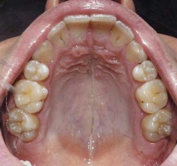 Focus on Dental Caries Management | Dentistry IQ