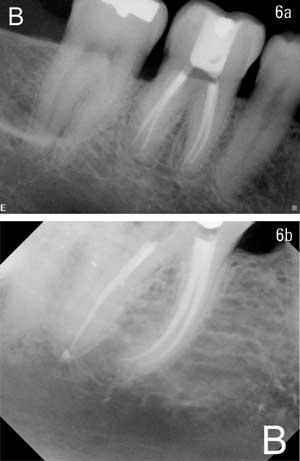 Introducing the Activ GP Precision Obturation System | Dentistry IQ