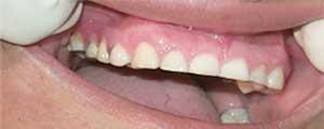 The beauty of Valplast® | DentistryIQ