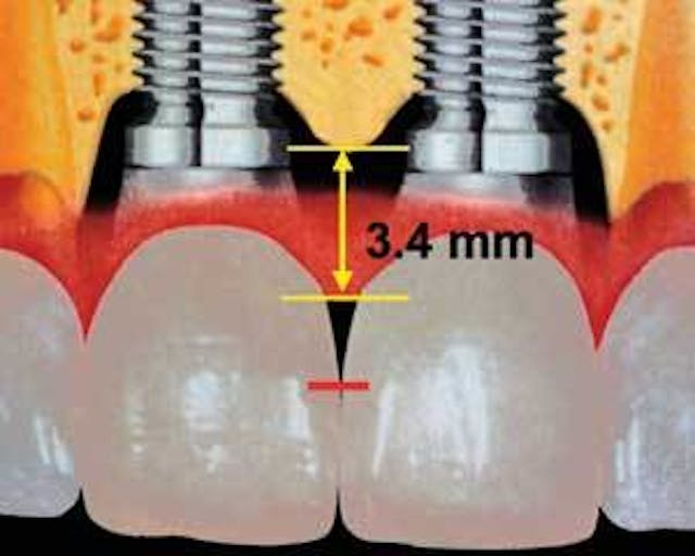 Immediate Load Implants | Dentistry IQ