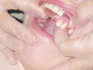 Valplast — The flexible partial | Dentistry IQ