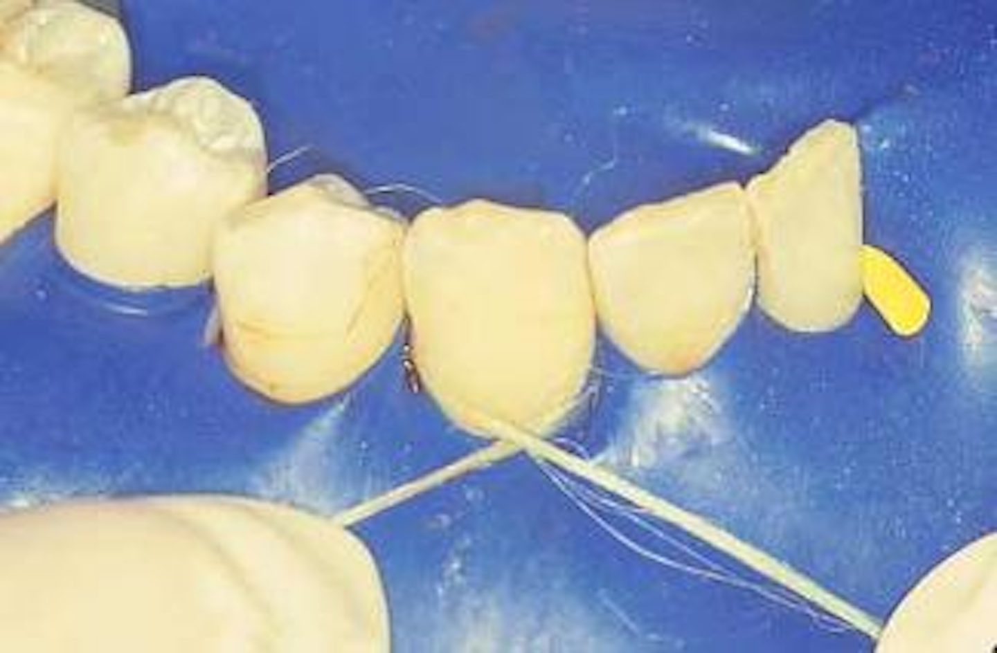 Secrets to successful dental dam placement | DentistryIQ