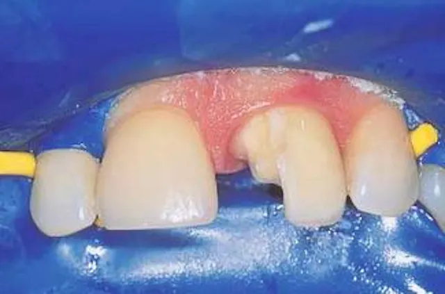 Secrets to successful dental dam placement | Dentistry IQ