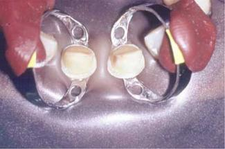 Secrets to successful dental dam placement | Dentistry IQ