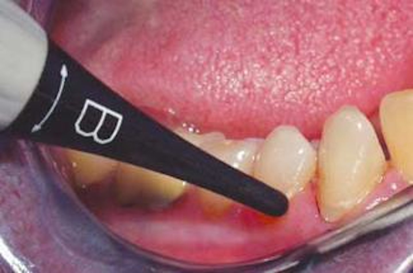 DIAGNOdent | DentistryIQ