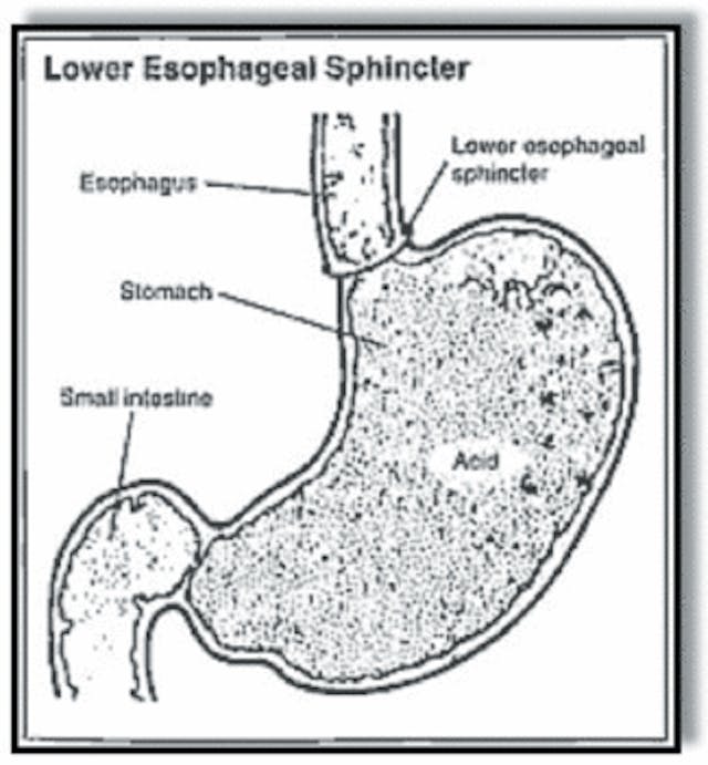 Understanding Acid Reflux and Its Dental Manifestations | Dentistry IQ