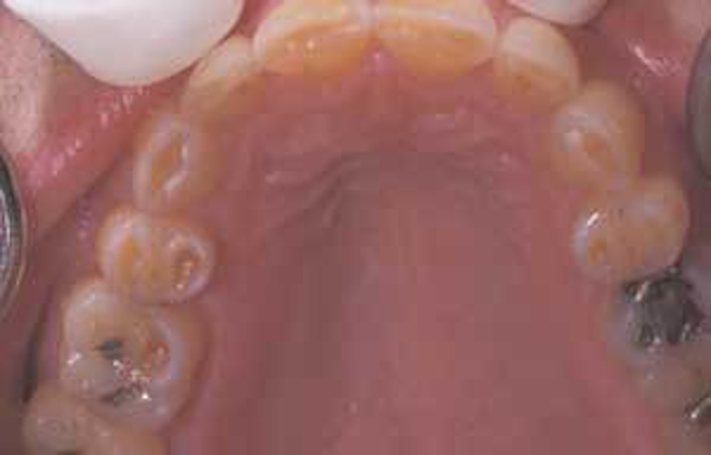 Understanding Acid Reflux and Its Dental Manifestations | DentistryIQ