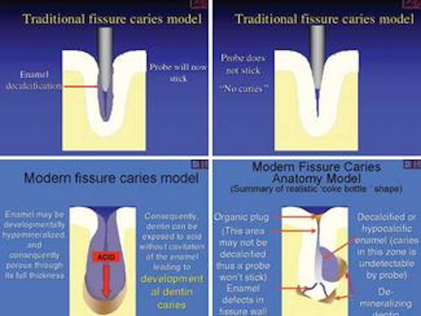 The science of caries diagnosis | DentistryIQ