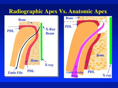 Endodontic insight: Where should the gutta-percha point end for optimal ...