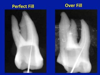 Endodontic insight: Where should the gutta-percha point end for optimal ...