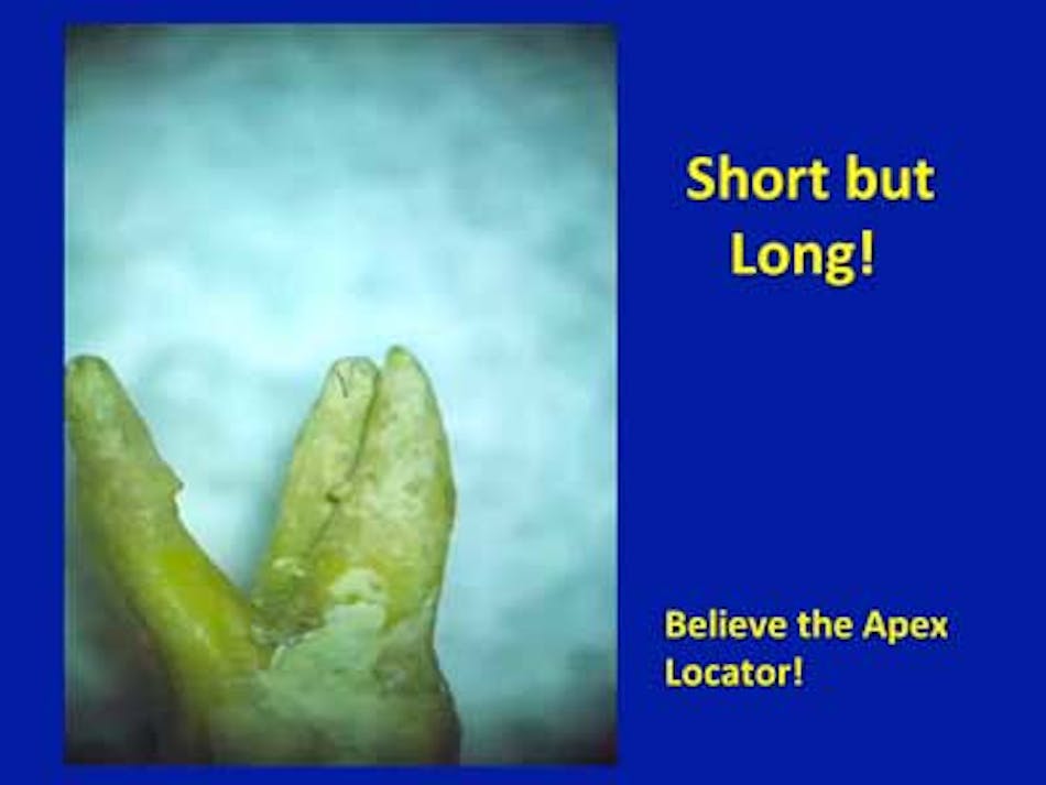 Endodontic insight: Where should the gutta-percha point end for optimal ...