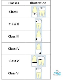 Must-know classifications of dental caries for the national dental ...