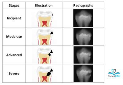 Stages Of Dental Caries 5 Stages Of Tooth Decay