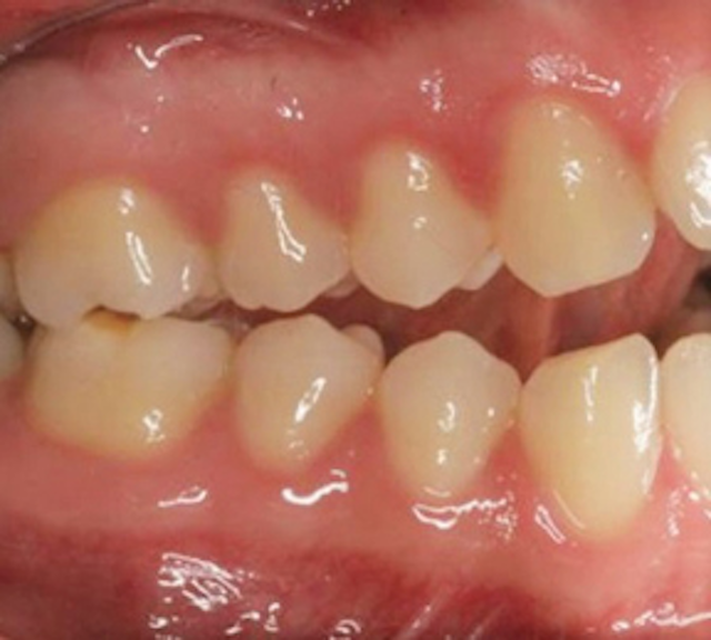Classifying occlusion: Board exam tips from StudentRDH.com | DentistryIQ
