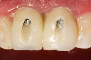 Fabrication of a chairside custom dental impression coping for fixture ...