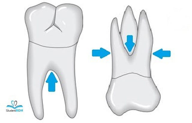 Summary of furcation defects for dental hygiene exams | Dentistry IQ