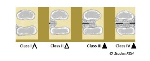 Summary of furcation defects for dental hygiene exams | Dentistry IQ