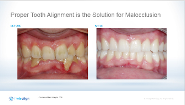 RDHs 'Align' together to raise awareness about proper tooth alignment ...