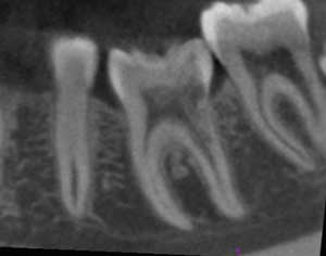Endodontics reference guide: Distinguishing differences between ...