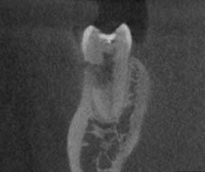 Endodontics reference guide: Distinguishing differences between ...