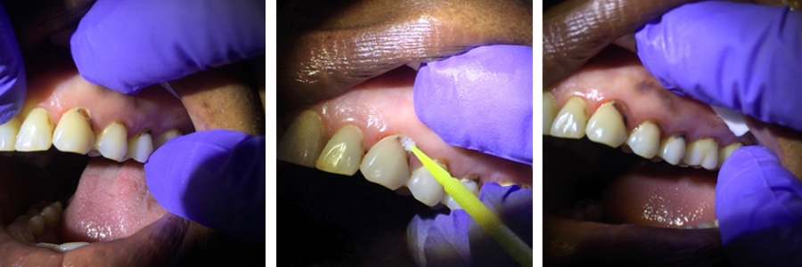 Silver diamine fluoride: A dental hygienist's perspective on the latest ...