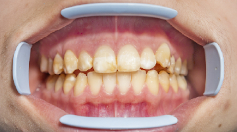 Hygiene Message In A Bottle Mailbag Fluoride Varnish And Fluorosis Hygiene Message In A Bottle Mailbag Fluoride Varnish And Fluorosis
