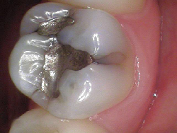Diagnosing what it's cracked up to be: A lesson in endodontics ...