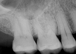 Diagnosing what it's cracked up to be: A lesson in endodontics ...