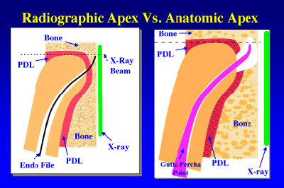Root canal treatment: Where does the apex end? | Dentistry IQ